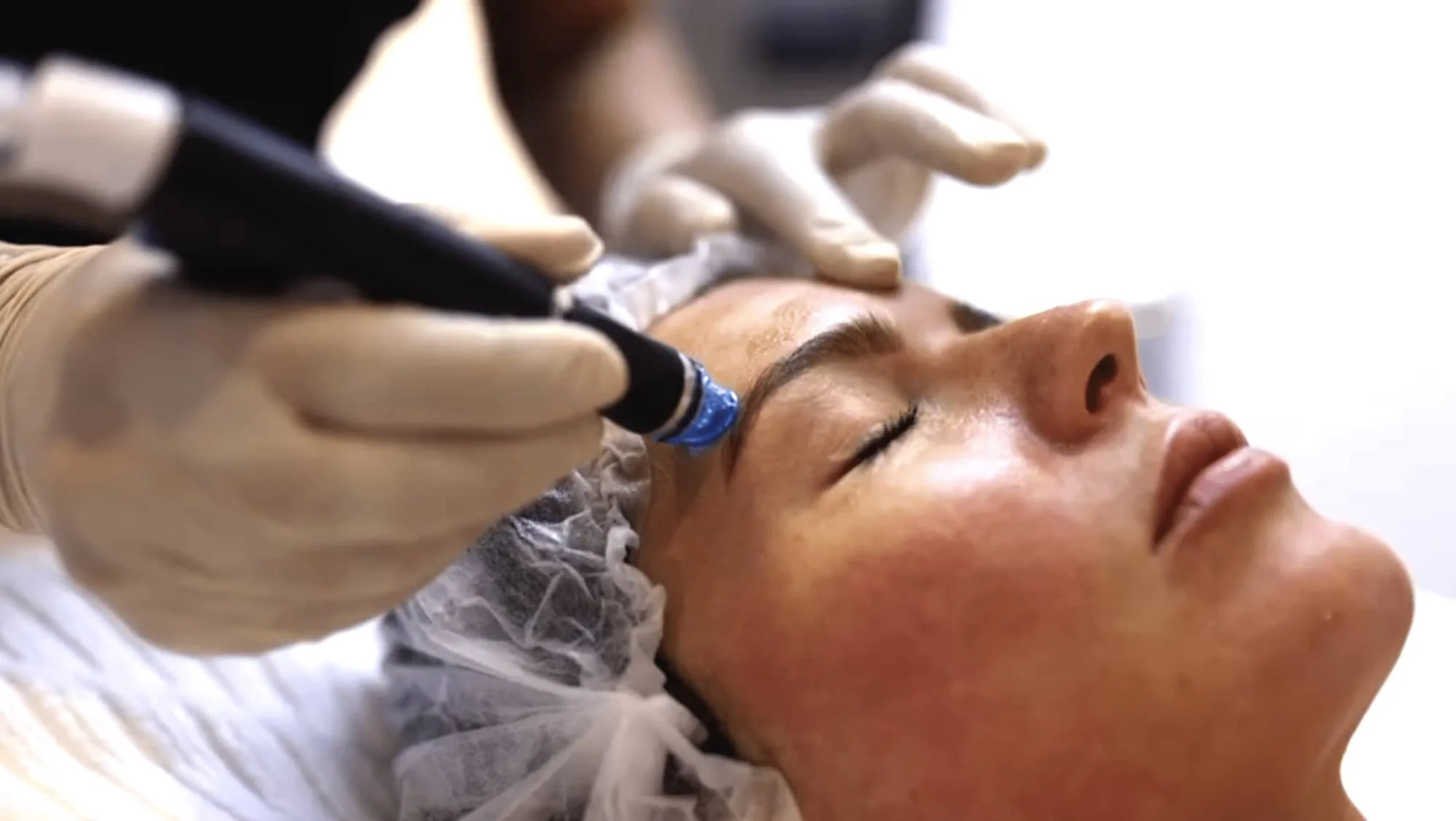 Hydrafacial Cannes - Centre esthétique à Cannes